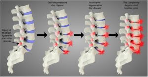 What is Lumbar stability! | TOPCHIRO UK | Milton Keynes